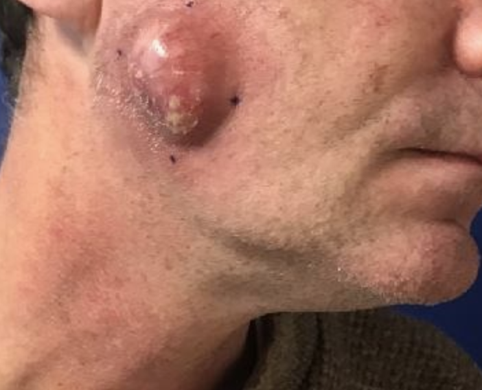 Sebaceous Cyst Face Removal Sebaceous Cyst Face Removal